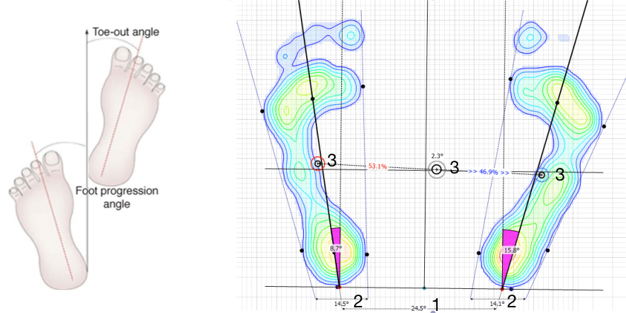 O que é o foot progression angle? Qual sua importância? - Kinetec